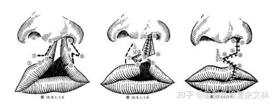 干货！唇裂三大基本修复术，唇裂必看系列！ - 知乎