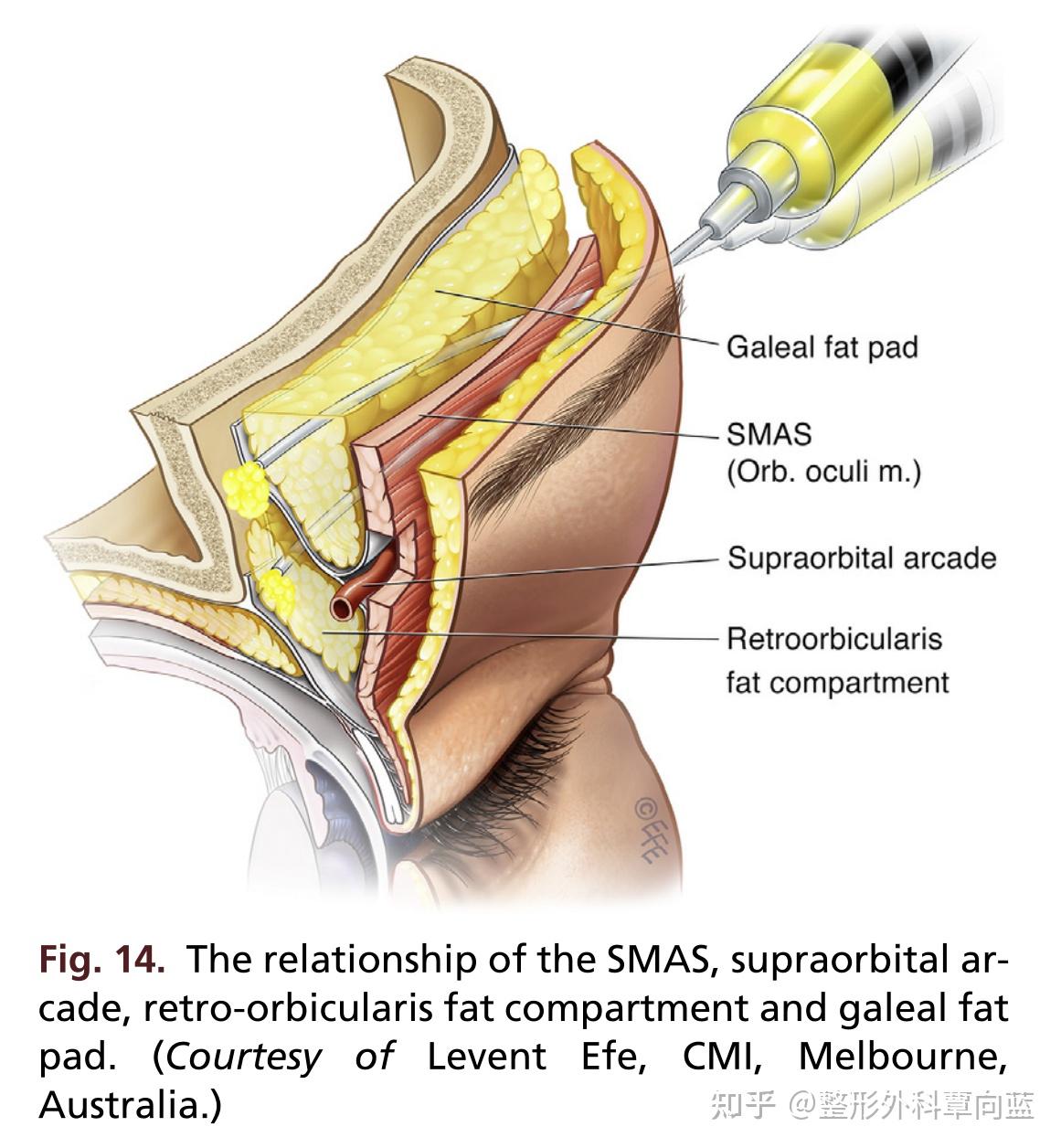基于SMAS韧带的注射指导，即所谓的“True Lift”注射技术 - 知乎