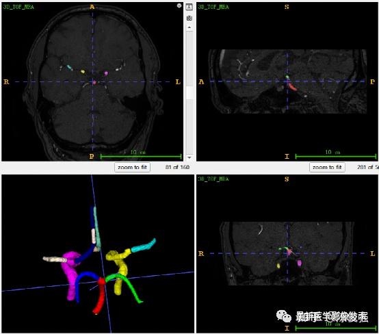 Top_Cow 2023——用于CTA和MRA的Willis环的拓扑解剖结构分割 - 知乎