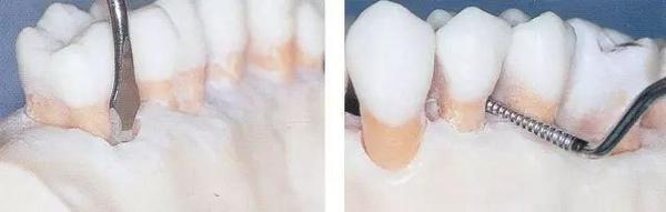 【牙周外科的基本技术技能】骨外科修整、缝合材料 - 知乎