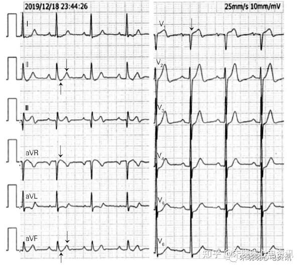 下壁导联的 de Winter ST -T 改变 - 知乎
