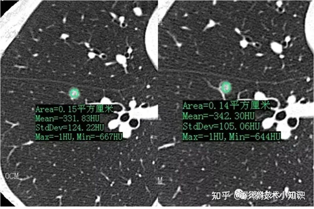 CT值的测量和运用 - 知乎