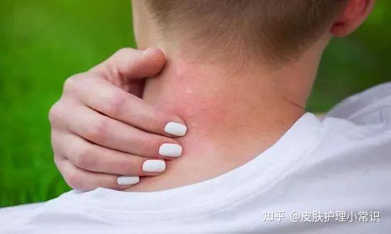 【肤康 科普】皮肤过敏反反复复，日常应该如何护理？ 深圳治过敏去哪个皮肤科 知乎