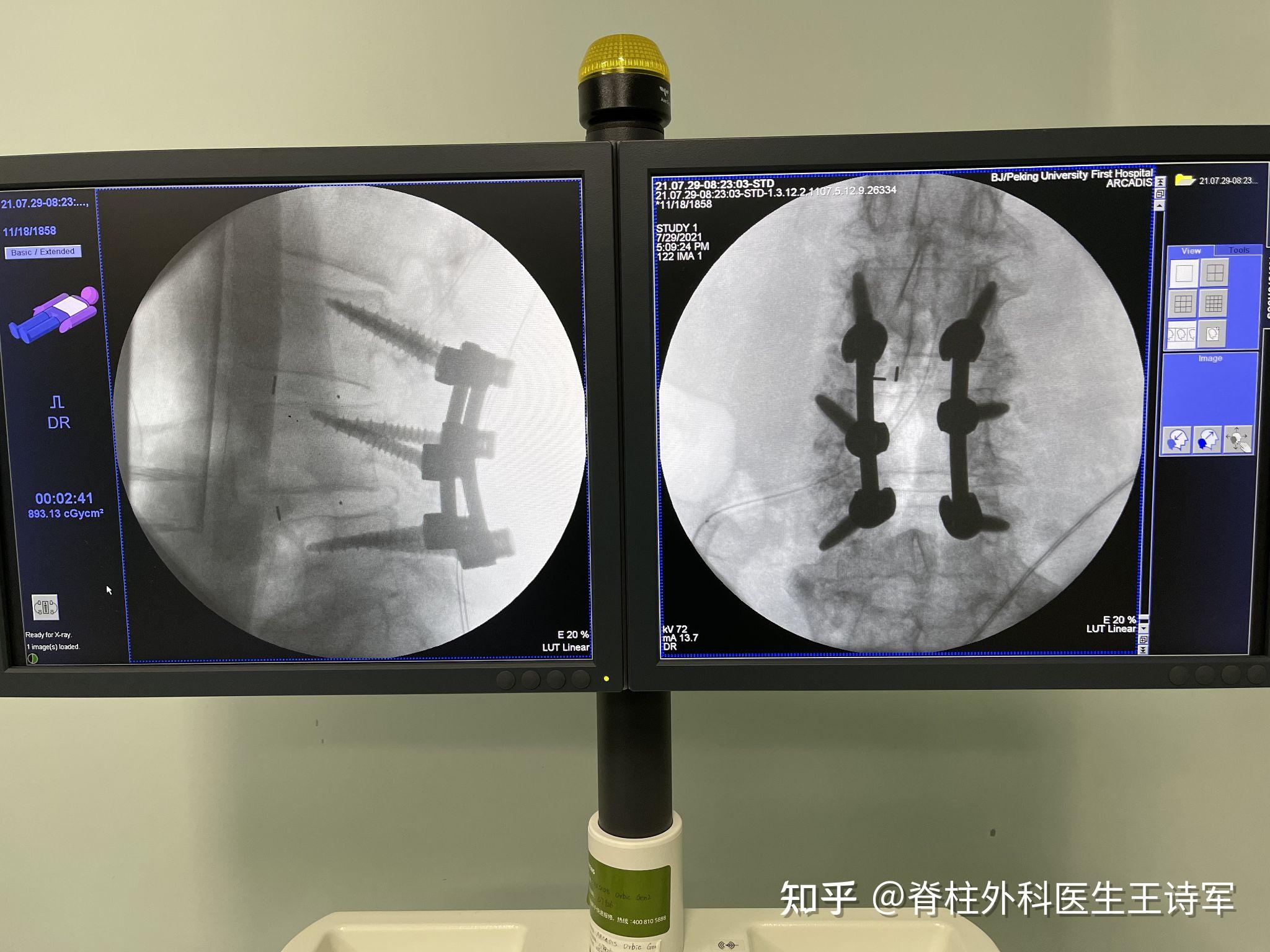 慢性肾功能不全接近透析老年患者行MIDLF手术 - 知乎