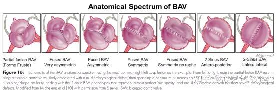 先天性二叶主动脉瓣及其主动脉病变命名和分类的国际共识声明 - 知乎
