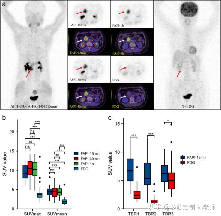 NOTA-FAPI PET/CT在各癌种中的临床应用 - 知乎