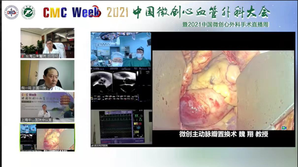 CMC Week 2021开启中国微创心血管外科新篇章 - 知乎