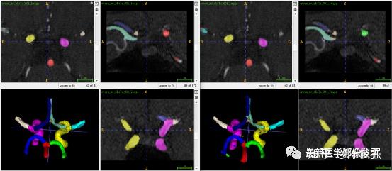 Top_Cow 2023——用于CTA和MRA的Willis环的拓扑解剖结构分割 - 知乎