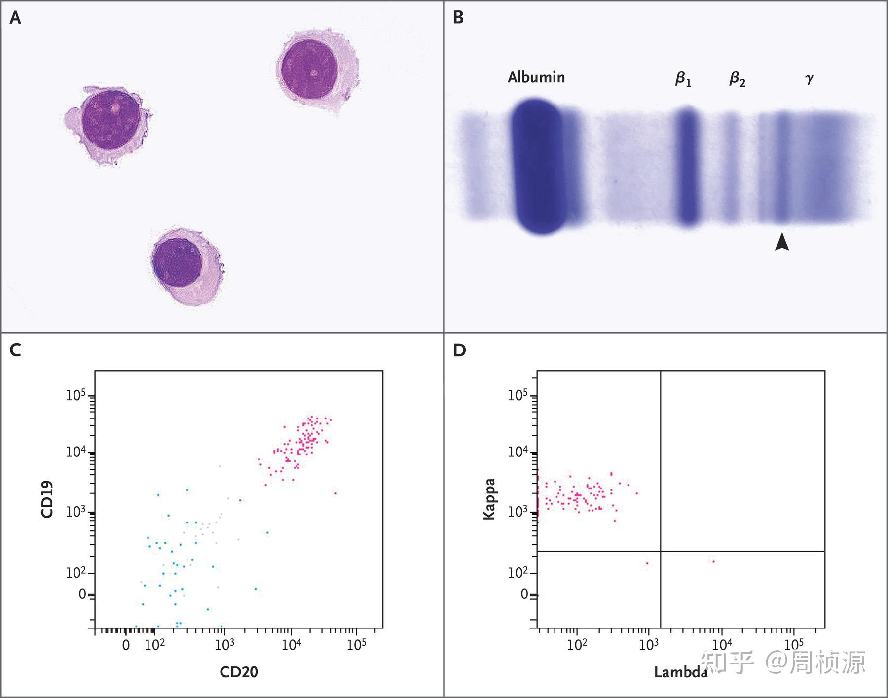 Nejm 2021 Case 6 - 知乎