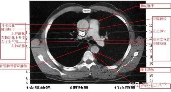 教你读懂胸部CT - 知乎