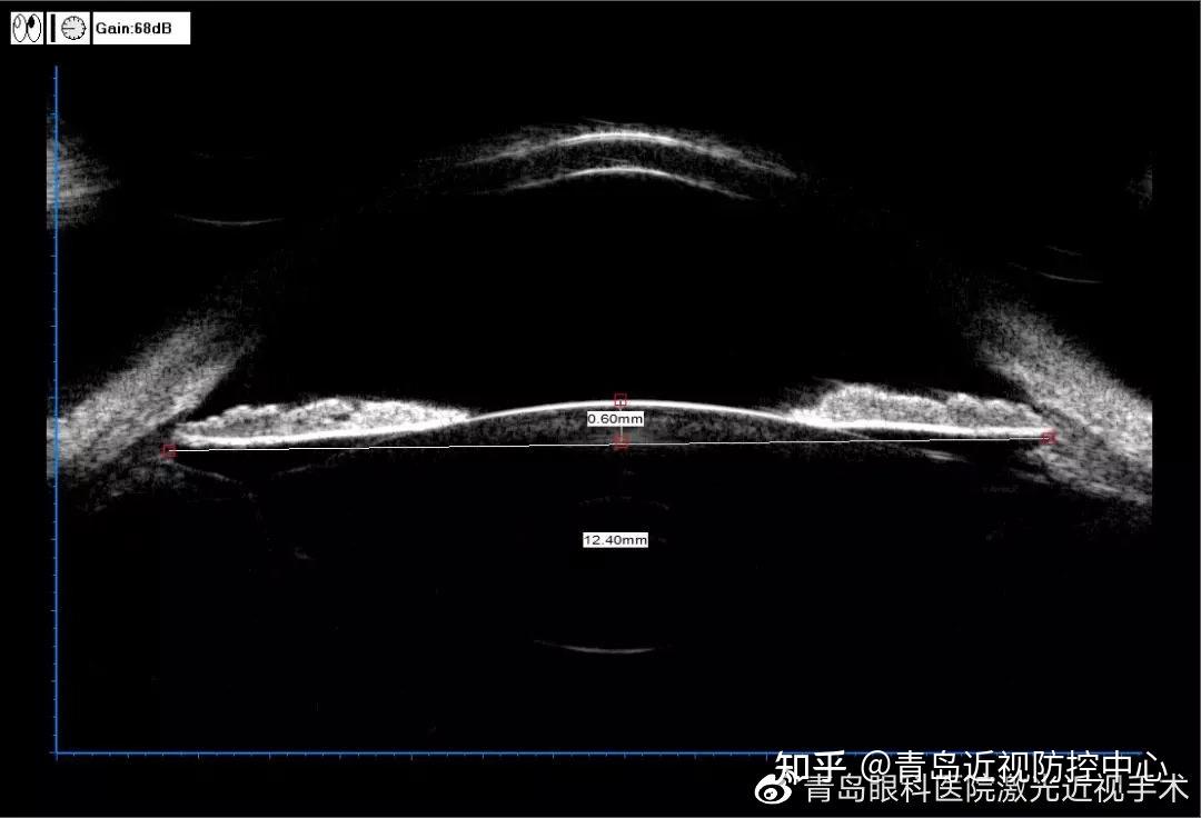 ICL晶体植入术前和术后要做哪些检查？一次说明白 - 知乎