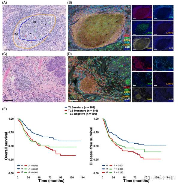 非因解读 | DSP空间转录组技术揭示食管鳞状细胞癌三级淋巴样结构的预后价值及分子特征 - 知乎