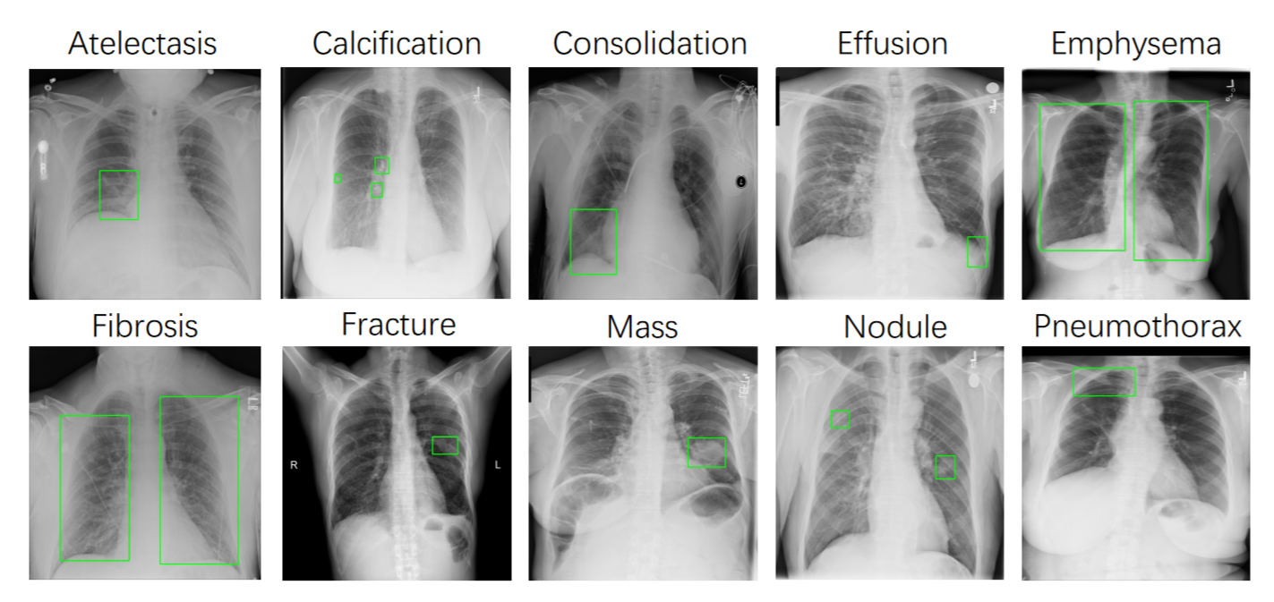 ChestX-Det10 胸畸形实例检测数据集介绍 - 知乎