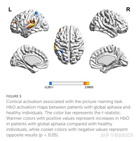 fNIRS应用 | 慧创fNIRS联同复旦大学附属华山医院吴毅教授 开展脑激活研究 - 知乎