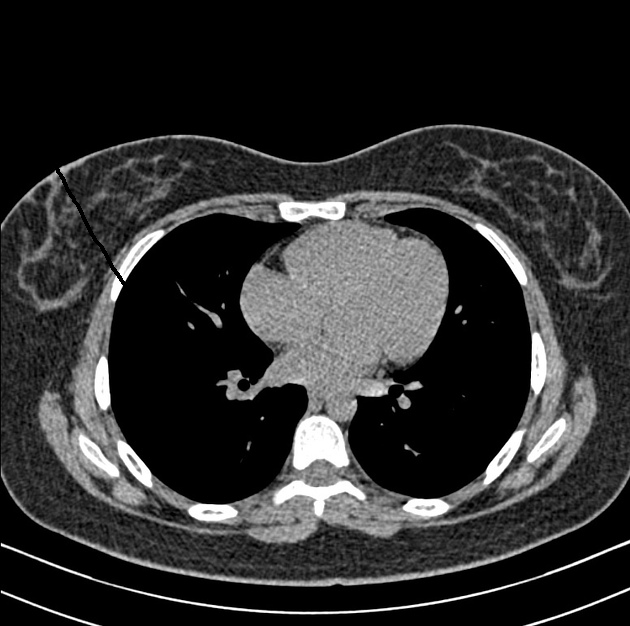 Chest CT-Scan images 数据集介绍 - 知乎