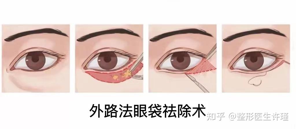 内切or外切眼袋手术手术有什么区别? 知乎