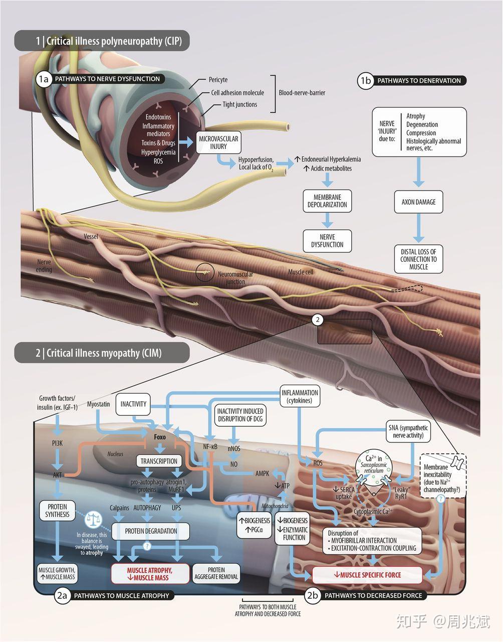 ICU-AW的影响及康复治疗 - 知乎