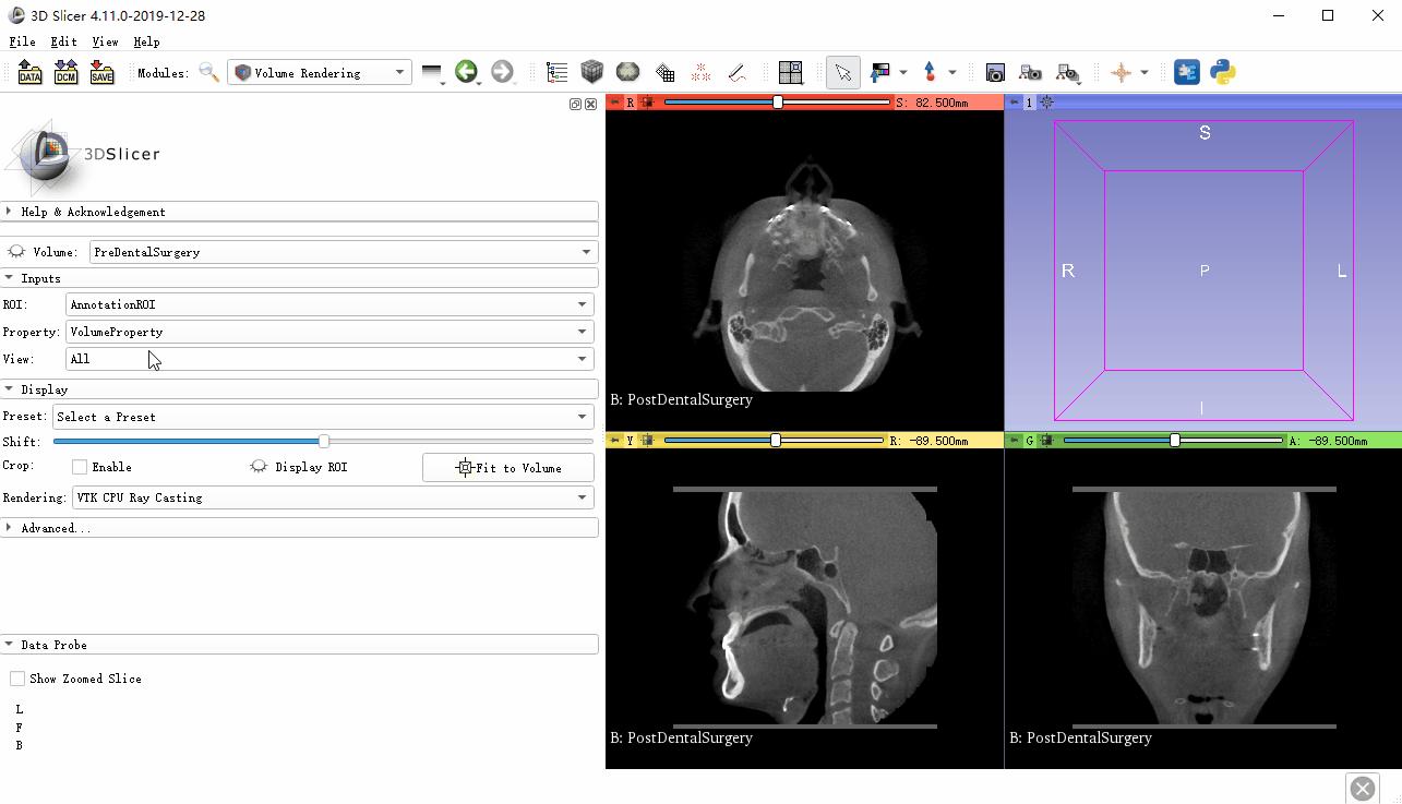 3D Slicer——选择感兴趣区，输出为DICOM序列 - 知乎