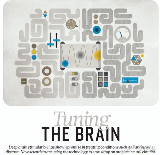 美敦力Percept PC脑起搏器治疗帕金森 - 知乎