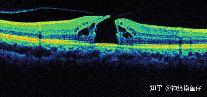 Chen et al. (2019) Retinal OCT Image Analysis 学习笔记 - 知乎