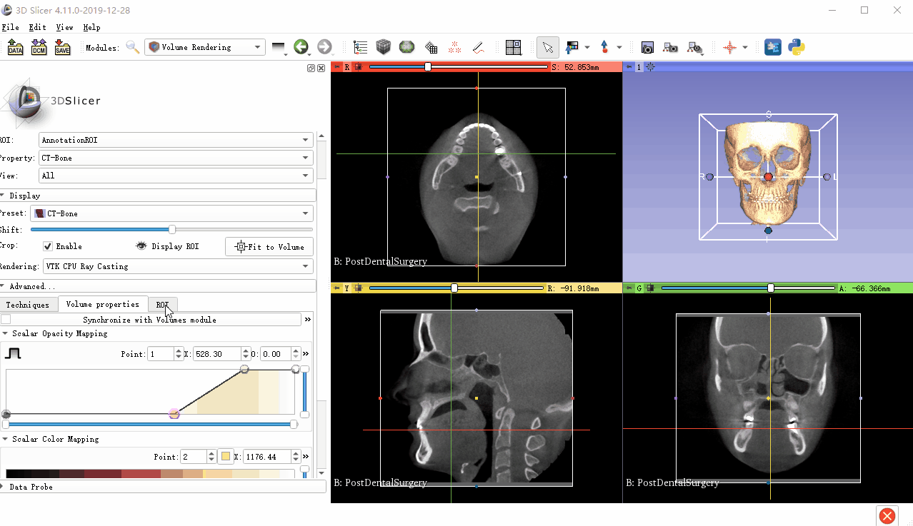 3D Slicer——选择感兴趣区，输出为DICOM序列 - 知乎