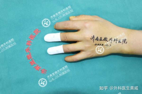 小伙遭遇“电锯惊魂”致四指缺损，这个再造手术给复原了！ - 知乎