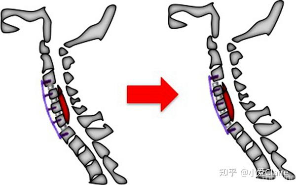 名医专访|上海长征医院脊柱外科缪锦浩：颈前路椎体骨化韧带前移融合术ACAF - 知乎