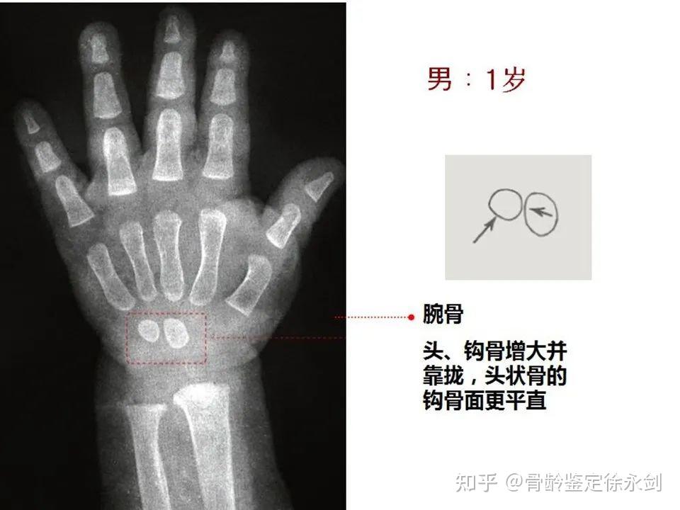 详解骨龄检测G-P骨龄图谱（男生版） - 知乎
