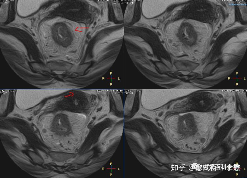 MRI星芒状伪影 - 知乎