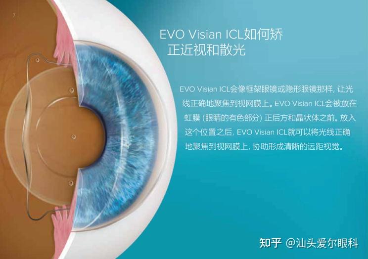 低度近视有没有必要做ICL晶体植入？ - 知乎