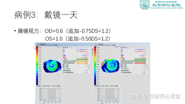 角膜地形图解读及露晰得塑形镜验配要点（文字版） - 知乎