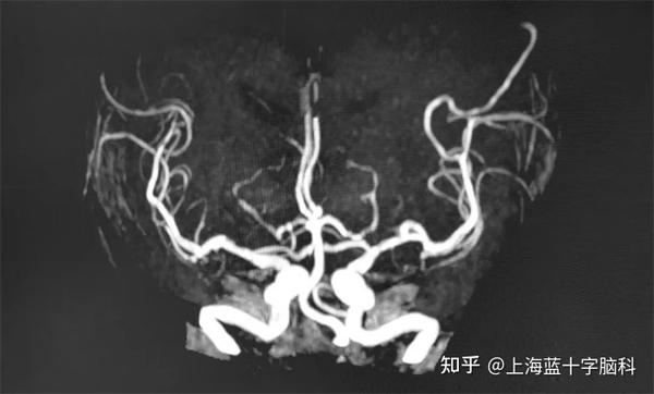 脑血管病做什么检查？专家解读：CTA、MRA、DSA - 知乎