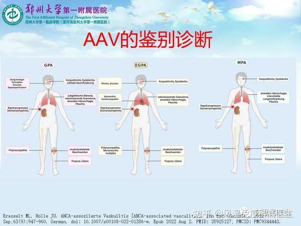 2022年ANCA相关血管炎诊疗进展 - 知乎