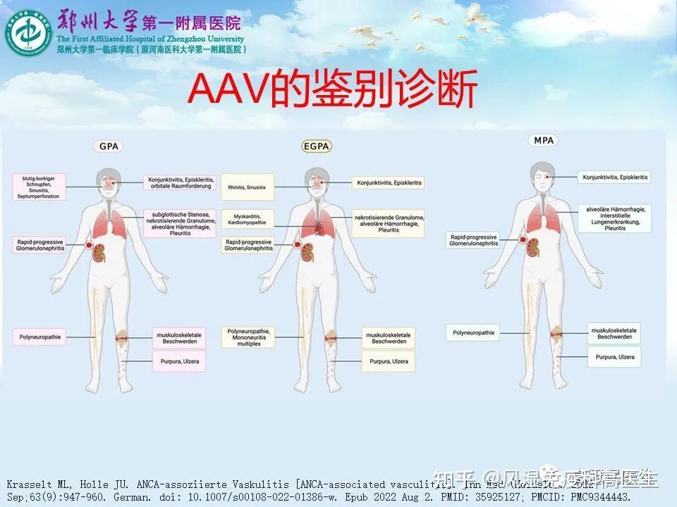 2022年ANCA相关血管炎诊疗进展 - 知乎