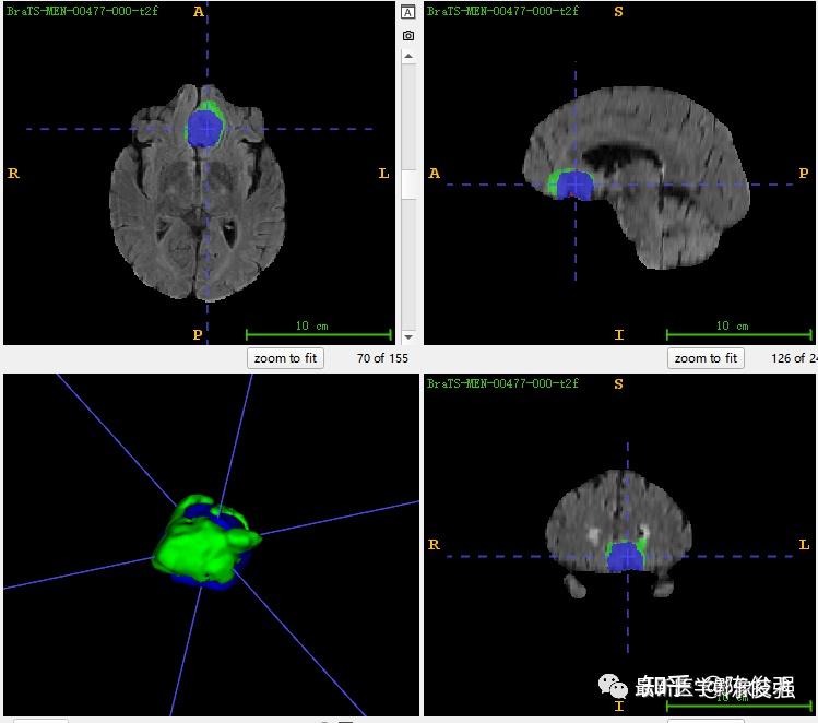 BraTS2023-MEN——BraTS2023颅内脑膜瘤分割挑战赛 - 知乎