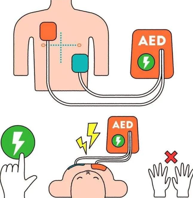 “救命神器”AED到底有多大用处?为何如此重要?AED这些常见的误区，你一定要知道！ - 知乎