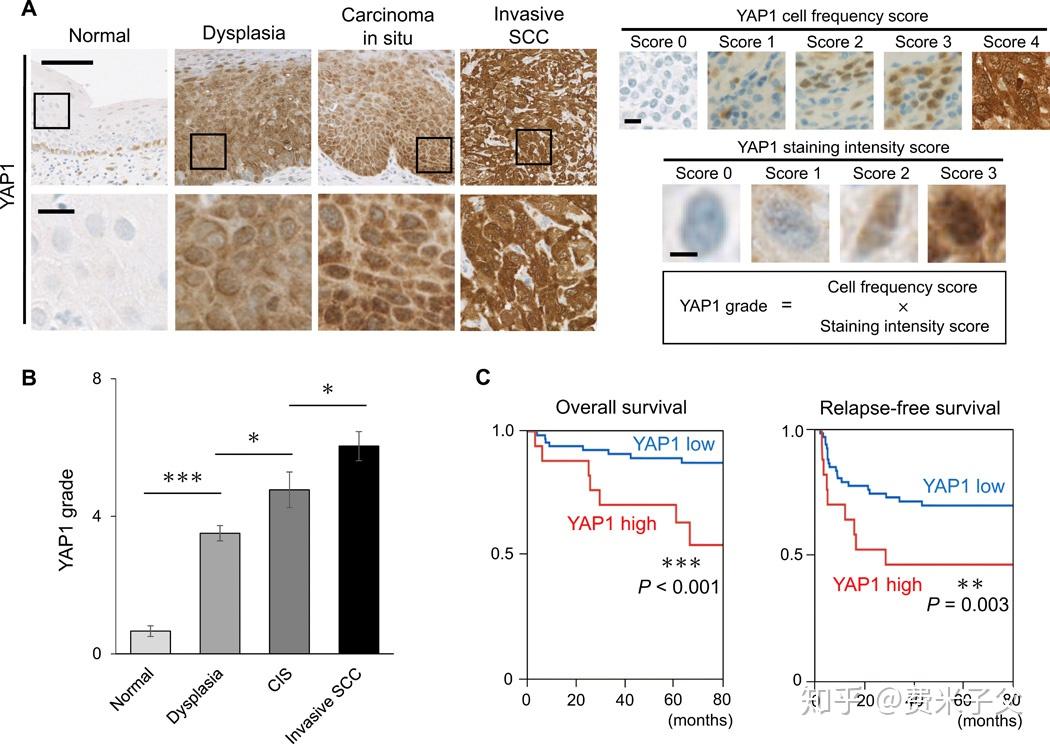 [科学]YAP1是口腔鳞状细胞癌的发病和进展的有效驱动因素。 - 知乎