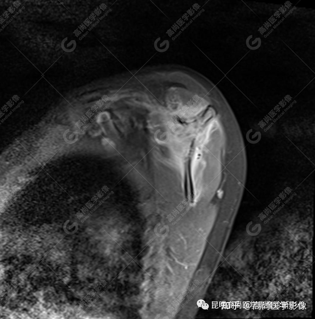 6岁儿童朗格汉斯细胞组织细胞增生症【高尚医学影像】 知乎