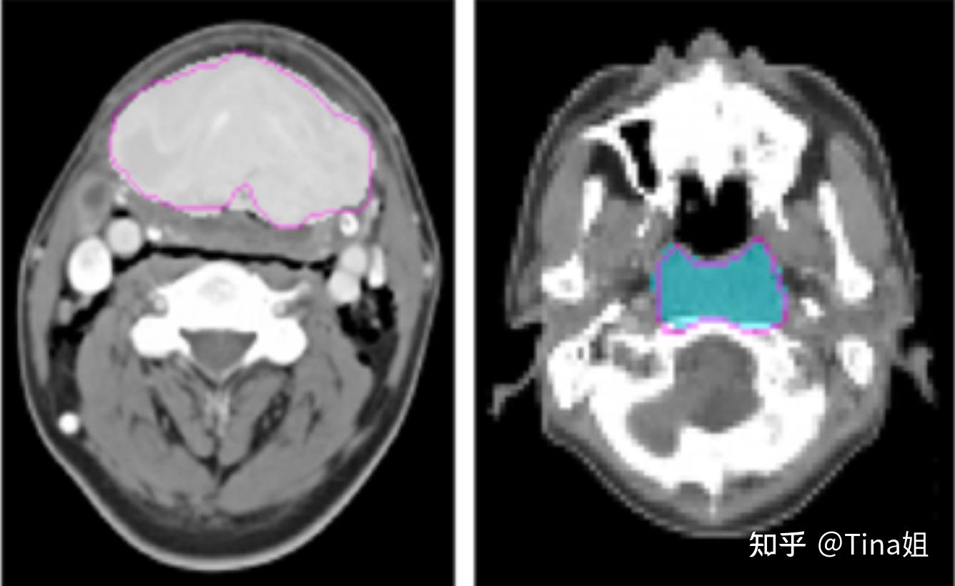 SCI 1区论文：Segment anything in medical images（MedSAM）[文献阅读] - 知乎
