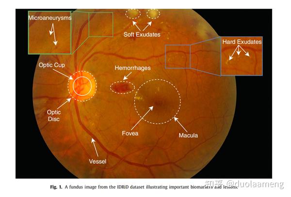 Applications of deep learning in fundus images: A review（一篇关于深度学习在眼底图像中的应用综述） - 知乎