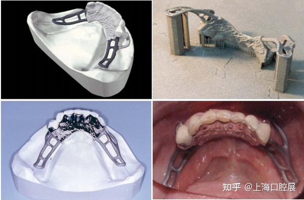 数字化技术在可摘局部义齿中的应用 - 知乎