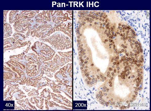 关于NTRK的一些必须了解的问题 - 知乎