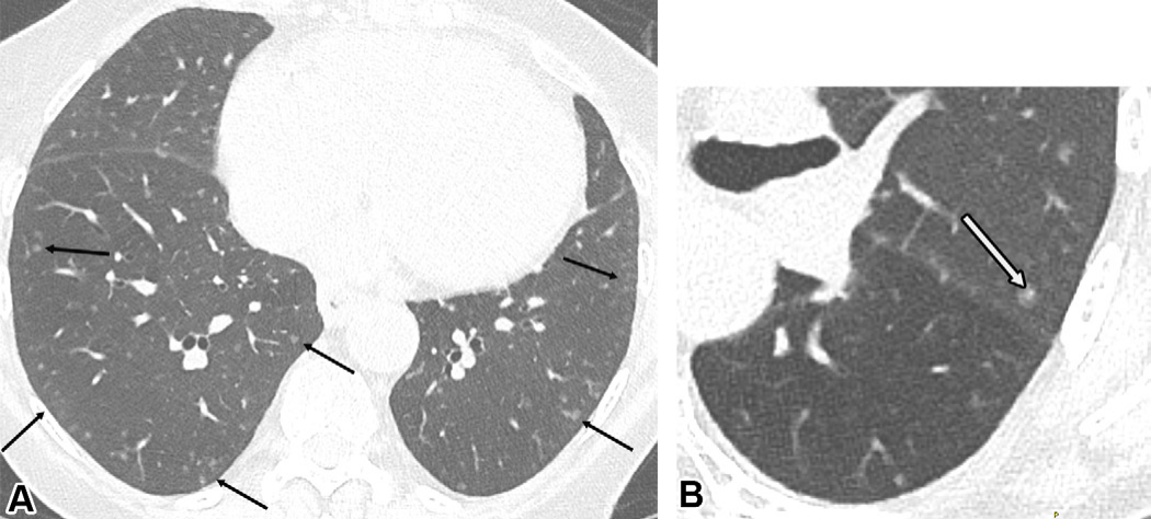 肺钙化与骨化：发病机制、CT表现及特定疾病 - 知乎
