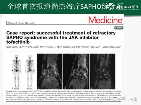 SAPHO综合征有哪些治疗方法？ - 知乎