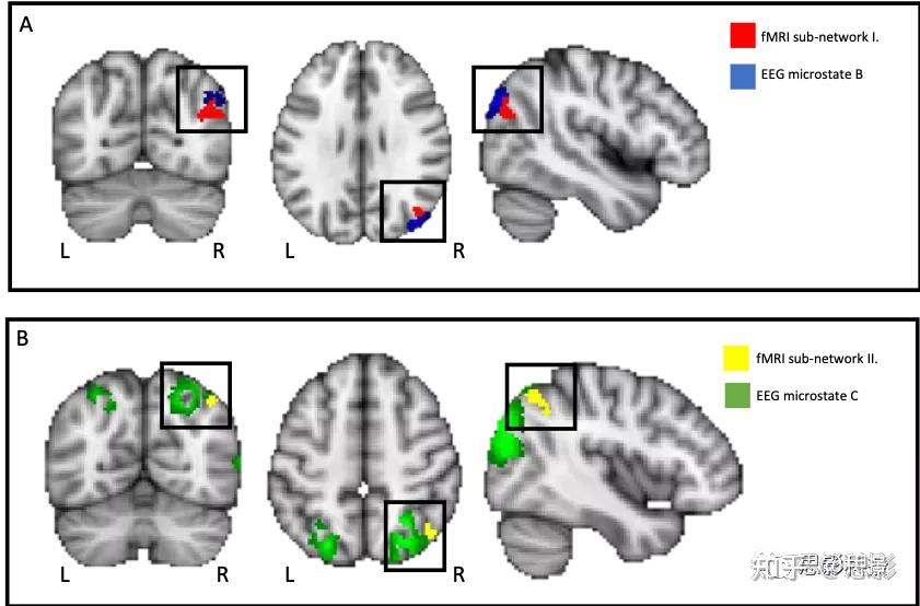 利用脑电和功能磁共振成像(fMRI)捕捉自我生成、任务启动的思维的时空动态 - 知乎